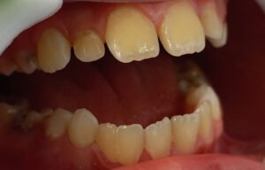 Gemination or dental fusion? Diagnostic dilemma. Case study - RJD