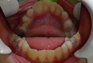 Gemination or dental fusion? Diagnostic dilemma. Case study - RJD